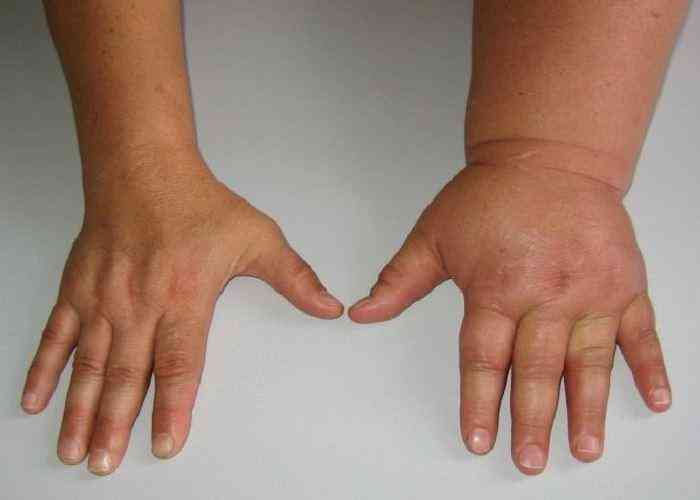 Fil Hastalığı Fil Ayağı Hastalığı Neden Olur Belirtileri Bitkisel Tedavi