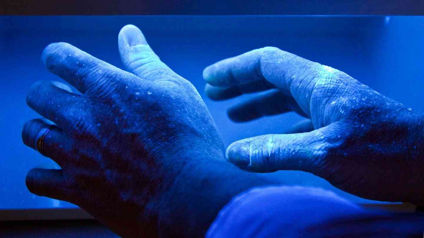 PUVA Tedavisi Nedir Zararları Fotokemoterapi Yan Etkileri Nelerdir?