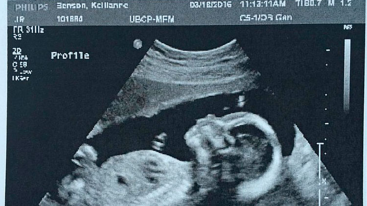 Obstetrik US Obstetrik Ultrasonografi Nedir Ne Zaman Çekilir