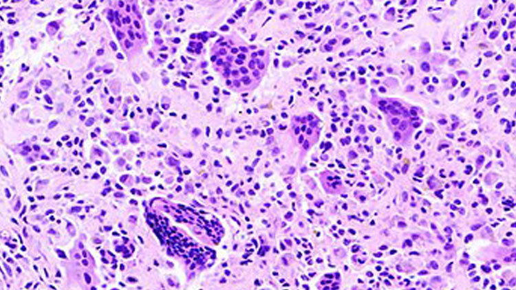 Granülom Nedir Neden Olur Belirtileri ve Tedavisi - Selmasultan