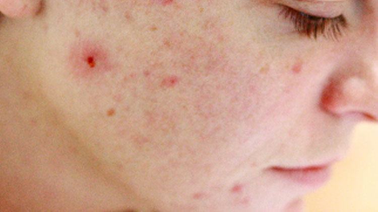 Akne Vulgaris Nedir Neden Olur Belirtileri Tedavisi İlaçları - Selmasultan